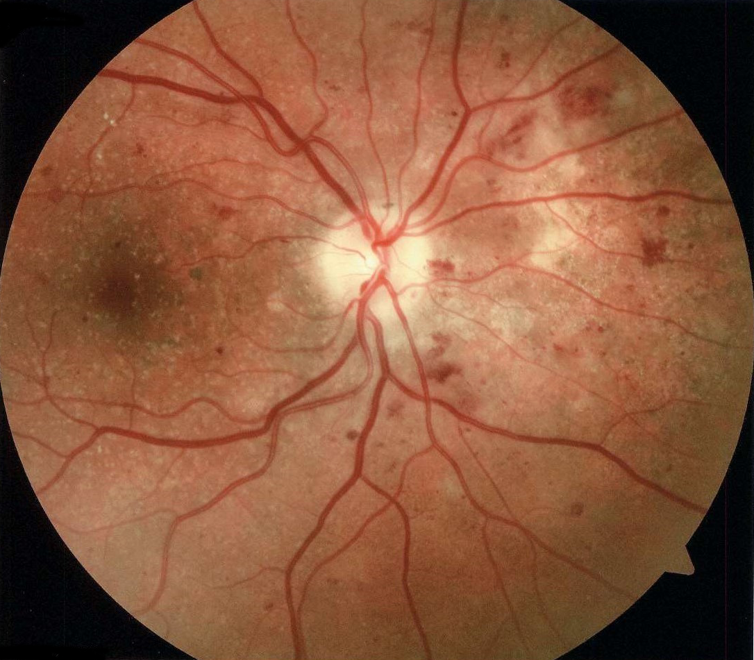 Diabetic Retinopathy - Planchard Eye & Laser Center